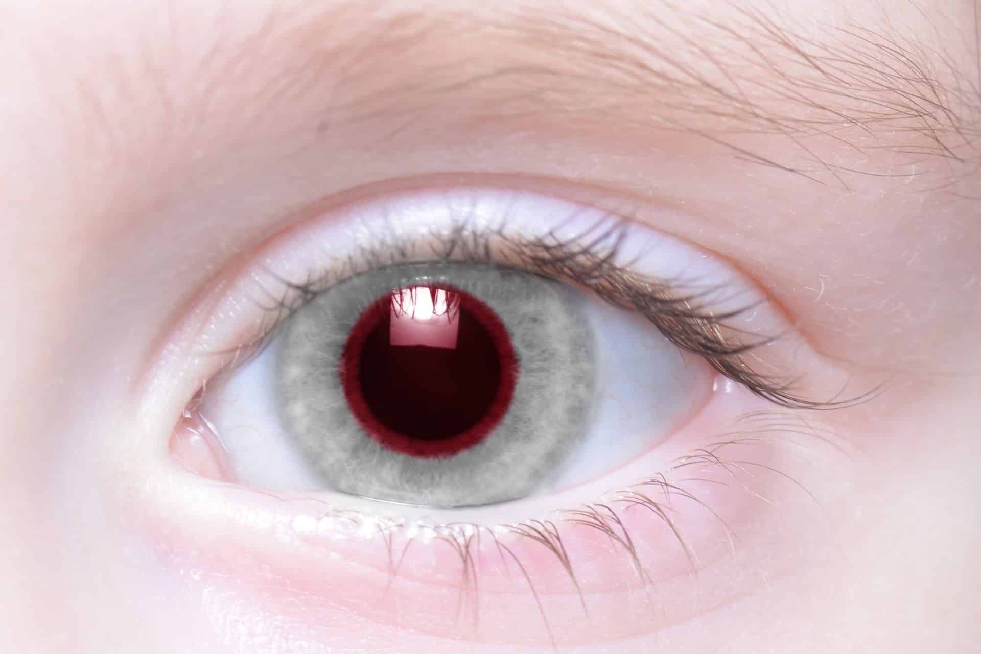 What Causes Red Eyes In Photos Milwaukee Eye Surgeons
