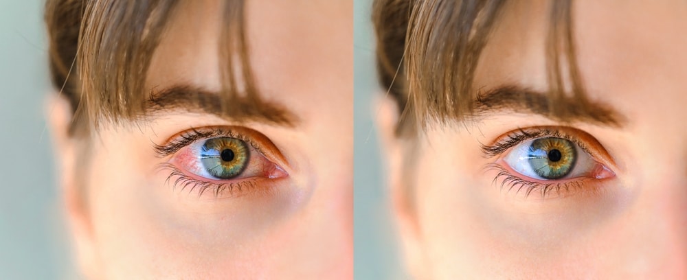 IPL Treatment for Dry Eye - Relieve Eye Discomfort Milwaukee